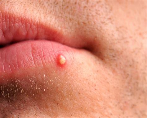 Pustules What Are They Causes Treatment Options And Prevention Tips