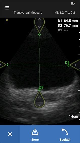 Bladder Volume App Vscan Extend