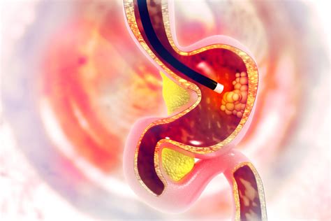 Ercp Treatment In Fort Collins And Greeley Co