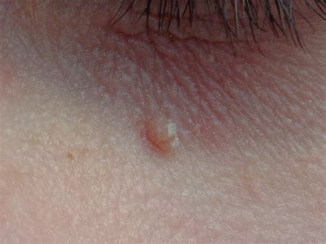 Foot Wart Treatment Options Types Of Warts On Feet Adelaide Foot Ankle