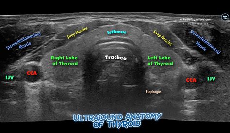 Isthmus Thyroid Ultrasound