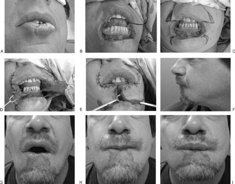 Lip Reconstruction Pmc