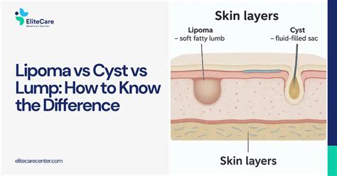 Lipoma Vs Cyst Vs Lump How To Know The Difference Elitecare Medical