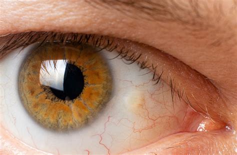 Pinguecula Vs Pterygium Whats The Difference Dr Bishop And Associates