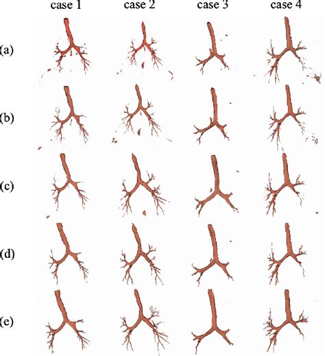 Figure 1 From A Branch Sensitive 3d Convolutional Neural Networks For Airway Segmentation