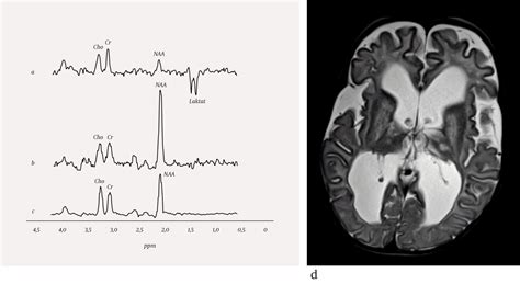 Clinical Mr Spectroscopy Of The Brain Tidsskrift For Den Norske