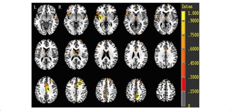 Brain Activation During The Stroop Task Of Control And SCH Groups R Download Scientific