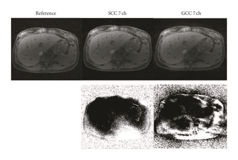 Comparison Of Scc And Gcc With 7 Virtual Coils For In Vivo Abdomen Data Download Scientific