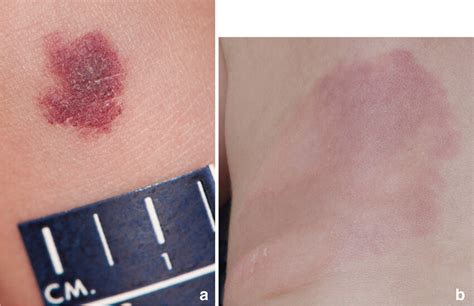 Capillary Malformations A Clinical Image From A 10 Year Old Girl Shows