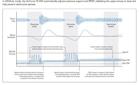Adaptive Servo Ventilation Asv Apnea Board Wiki