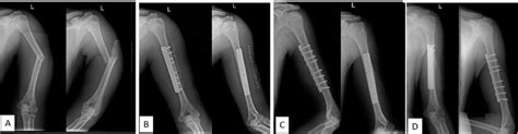 A Radiograph Showing Fracture Middle Third Shaft Of Humerus At Download Scientific Diagram