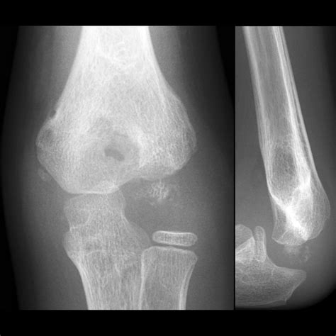 Panner Disease Pediatric Radiology Reference Article Pediatric