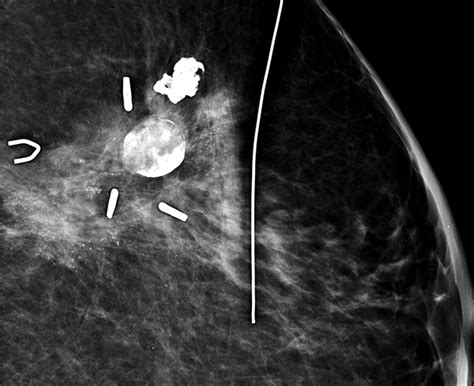 Magnetic Seed Lumpectomy At Harrison Trethowan Blog