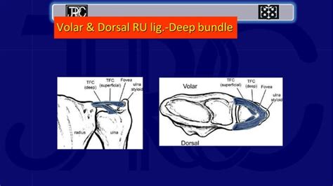 Tfcc Triangular Fibro Cartilage Complex Injury Ppt