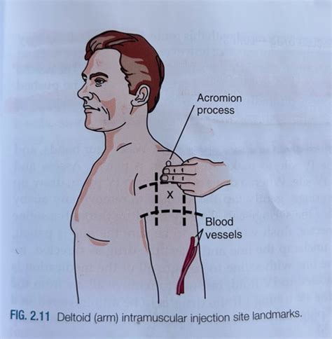 Ch 2 Safely Preparing And Giving Drugs Ch 35 Administering Intradermal Subcutaneous