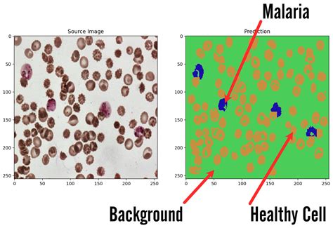Malaria Detection Using Advanced Deep Learning Architecture