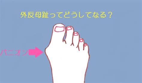 「外反母趾」（がいはんぼし）とは？痛み始めの対策が大切。