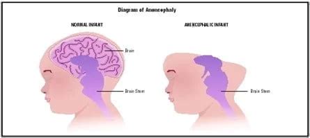 Anencephaly Diagram