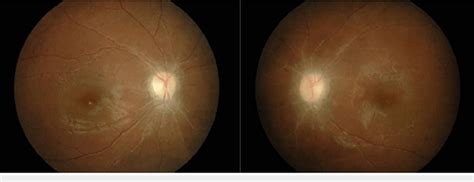 Bilateral Optic Disc Atrophy With Attenuated Arteriolar And Dilated Veins Download Scientific
