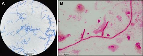 Invasive Pulmonary Infection Caused By Trichoderma Longibrachiatum Thorax