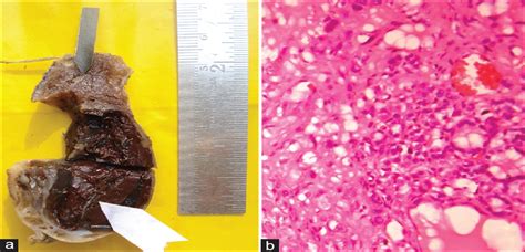 Indian Journal Of Cancer