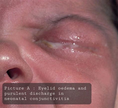 🔵neonatal Conjunctivitis Ophthalmia Neonatorum Conjunctival Themba Madlala