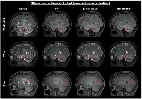 Joint Multi‐contrast Variational Network Reconstruction Jvn With Application To Rapid 2d And