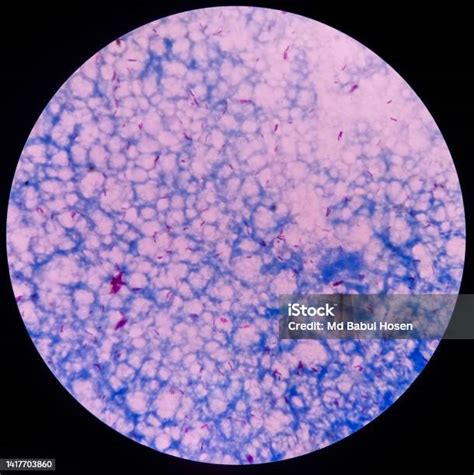 Afb 스테인릭의 현미경 100x 이미지 마이크로 박테리움 결핵 박테리아 가래 또는 가래 얼룩 건강 진단에 대한 스톡 사진 및 기타 이미지 Istock