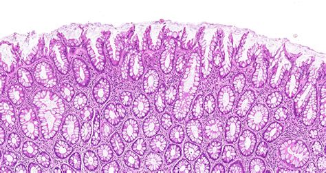 Hyperplastic Polyp Pathology Outlines Clinical Pathology Intestinal
