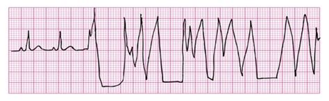 Ecg Artifacts Flashcards Quizlet