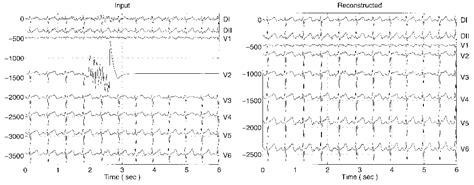 pdf svd based on line exercise ecg signal orthogonalization 1999