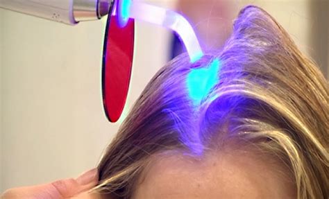Hair Transplant Alternatives Non Surgical Options