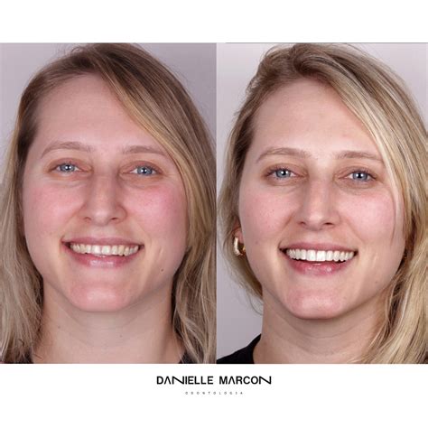 Danielle Marcon Cirurgiã Dentista Dradaniellemarcon • Instagram