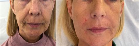 Achieving A Youthful And Natural Look With Aesplla Polylactic Acid