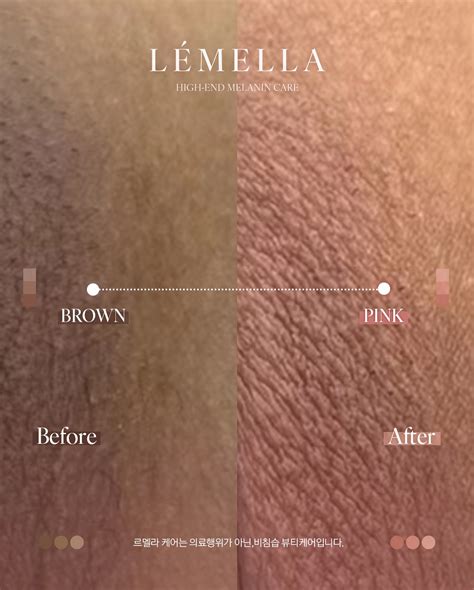 르멜라 본사 하이엔드 멜라닌 색소침착 케어 𝑯𝒊 𝑨𝑵𝑫 𝑴𝑬𝑳𝑨𝑵𝑰𝑵 𝑪𝑨𝑹𝑬 르멜라 르멜라 공식인증 멜라티스트 오너프룸” Onufgangnam 누가 하느냐에
