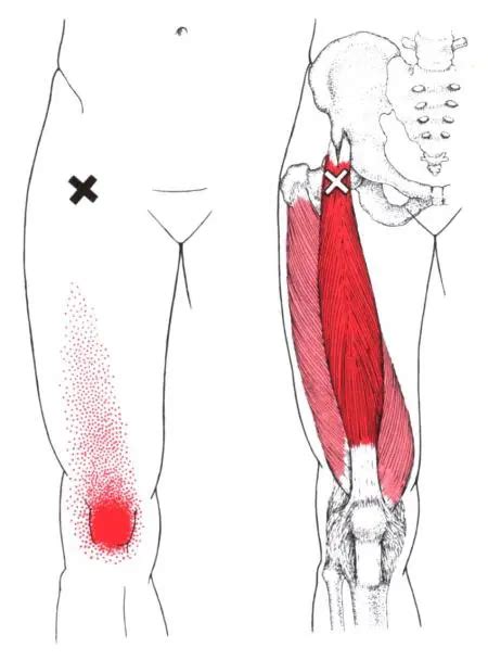 Quadratus Femoris Trigger Point Frontiers Advancing Musculoskeletal