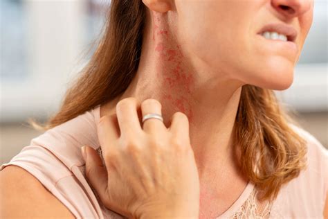 24 Hours Allergic Reaction Treatment Near You Rapidcare Emergency Room