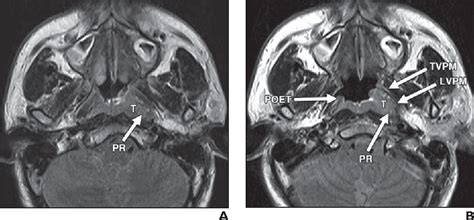 Table 3 From Functional Mri Of The Eustachian Tubes In Patients With