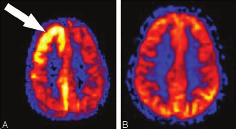 Patient 1 A Quantitative Cbf Map Generated From The Asl Sequence Download Scientific Diagram