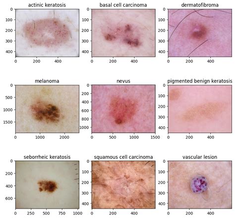Github Kiransalagare Melanoma Detection Case Study