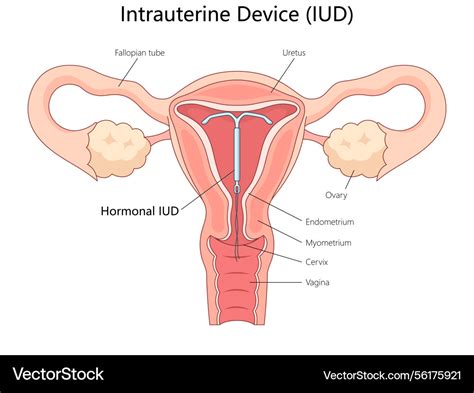 Hormonal Intrauterine Device Iud Diagram Medical Vector Image