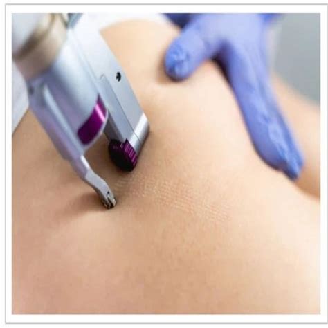 Laser Assisted Hatching In Hyderabad Id 2849237085062