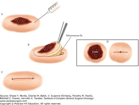 Excision Biopsy Break Down The Differences Between Excision And