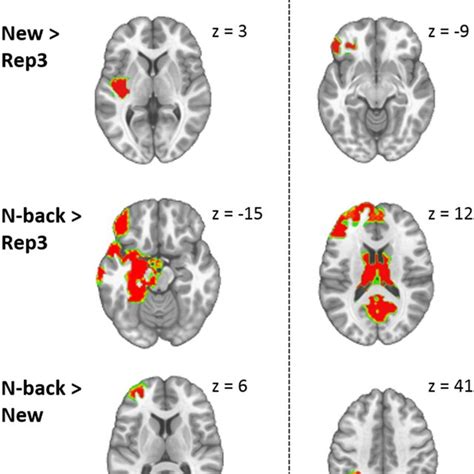Neural Source Estimations In Controls Figure Displays The Post Hoc Download Scientific Diagram