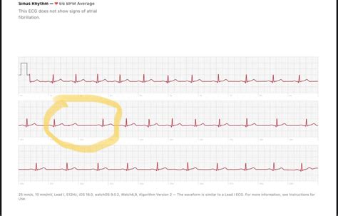 Thoughts On If This Is A Pac Or Pvc R Readmyecg