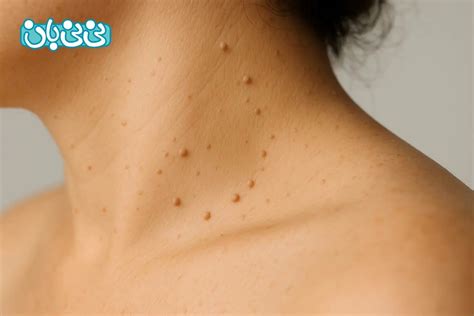 منگوله پوستی چیست و آیا واگیر دارد؟ روش‌های درمان پزشکی و خانگی