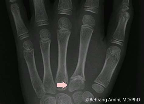 Roentgen Ray Reader Accessory Epiphysis Pseudoepiphysis
