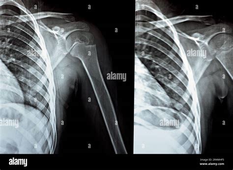 Clavicle Hairline Fracture