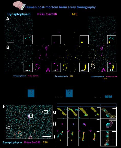 P Tau Ser356 Co Localises At The Synapse In Alzheimers Disease