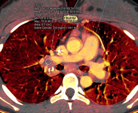 Dual Energy Ct Material Decomposition In Pediatric Thoracic Oncology Radiology Imaging Cancer